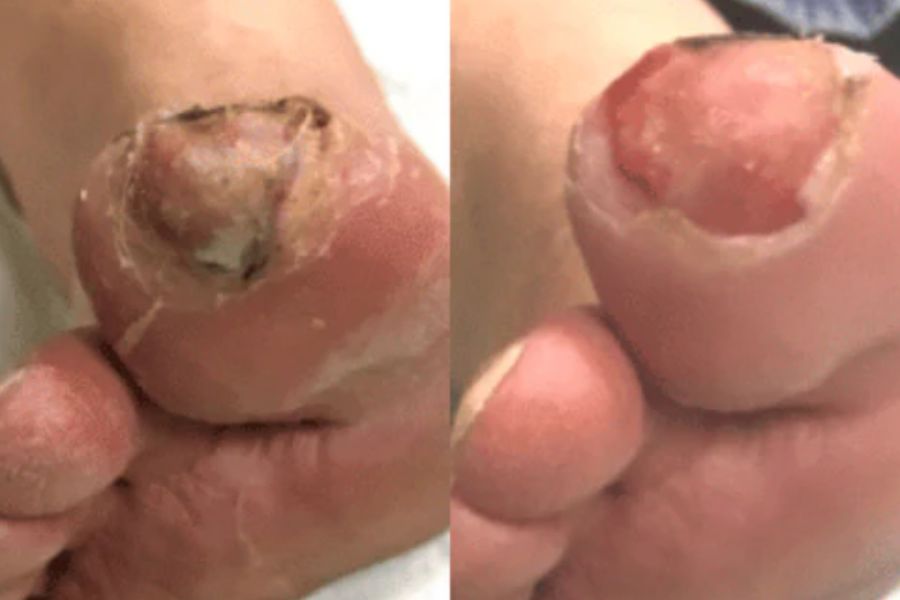 Case Study – Diabetic Toe Ulcer – Lavior