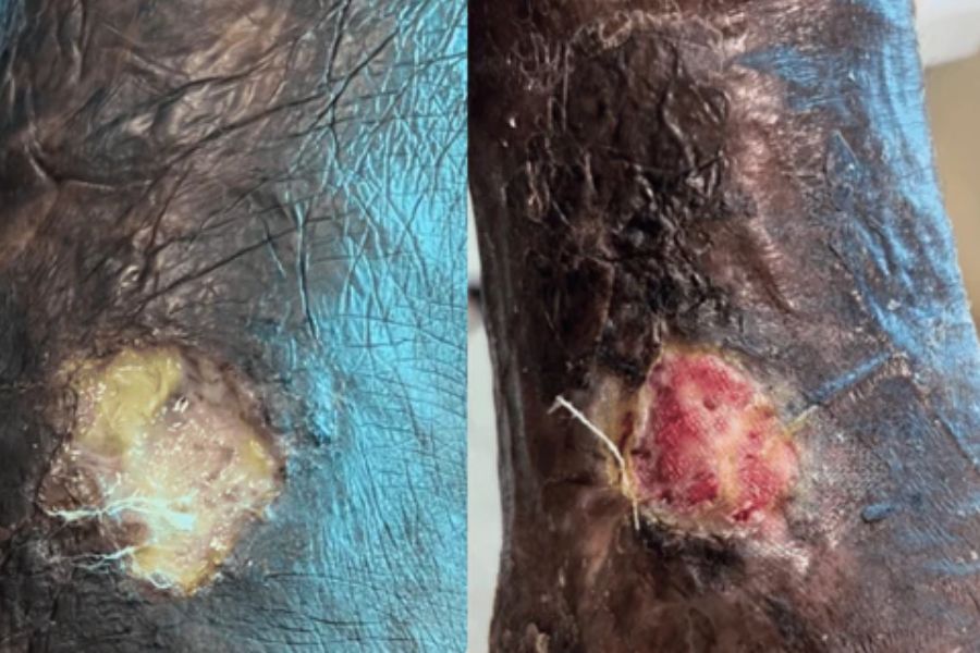 Case Study – Medial Malleolus Ulcer – Lavior